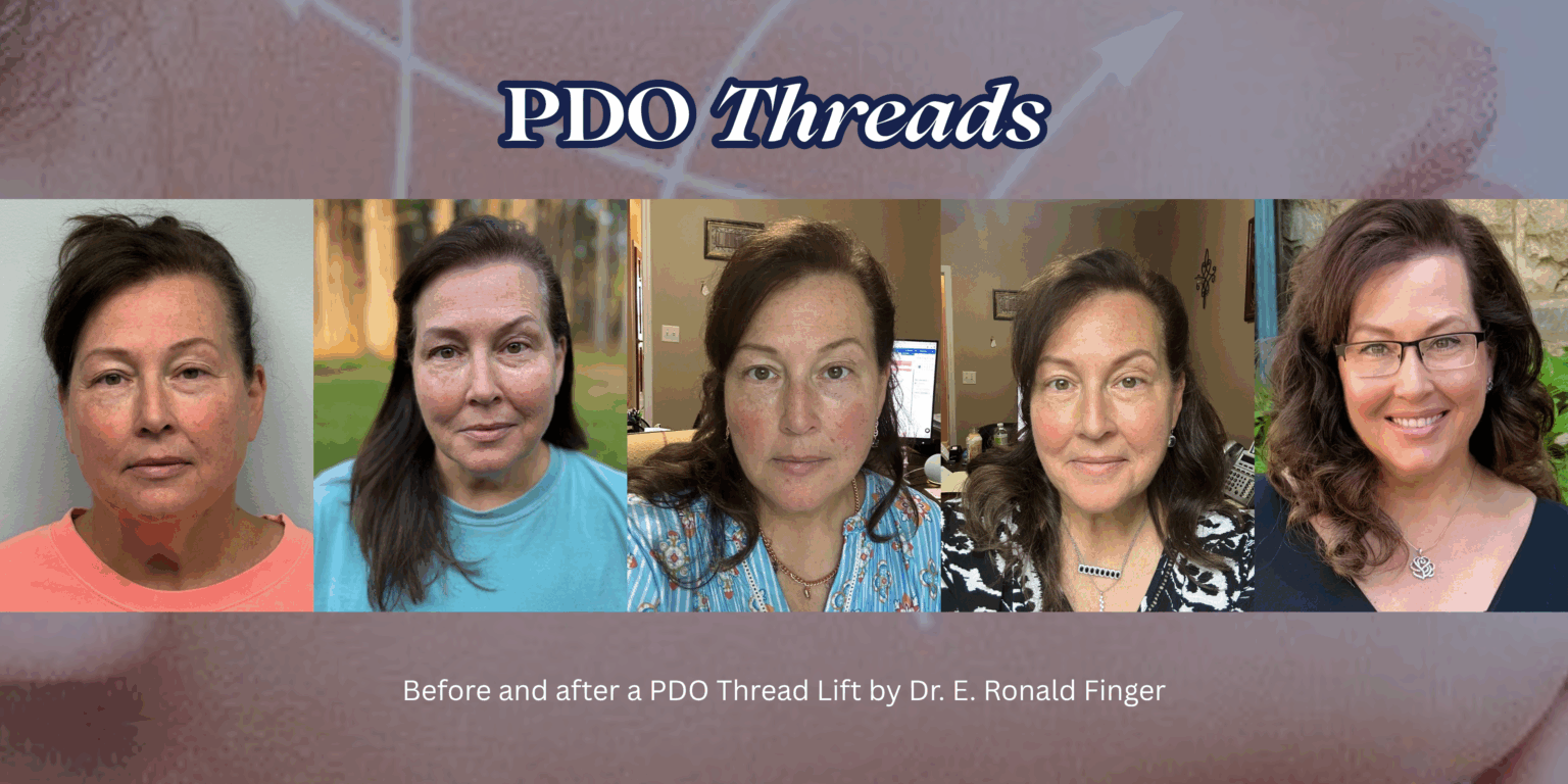Before and after a PDO Thread Lift by Dr. E. Ronald Finger - Finger ...
