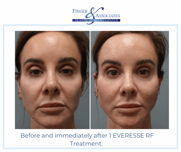 Everesse RF for lifted, glowing skin with no downtime