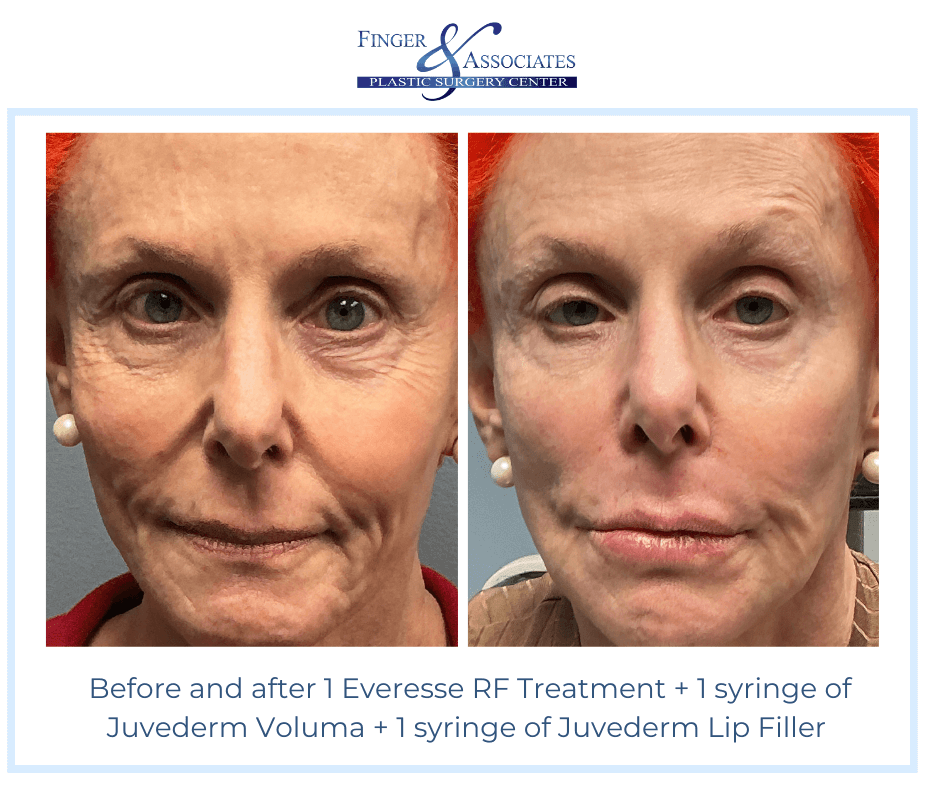 Before and after 1 Everesse RF Treatment + 1 syringe of Juvederm Voluma ...